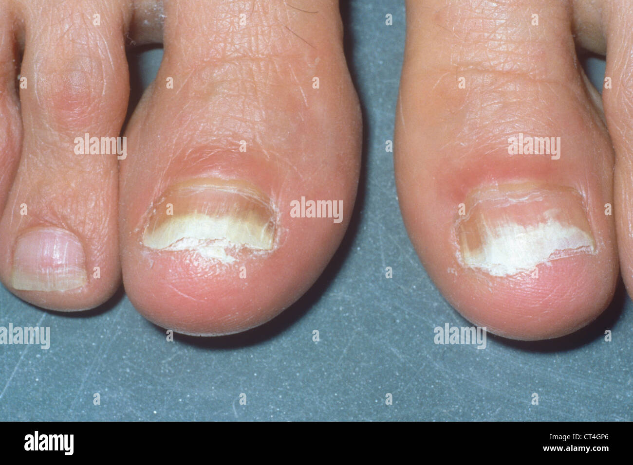 Onychia hi-res stock photography and images - Alamy