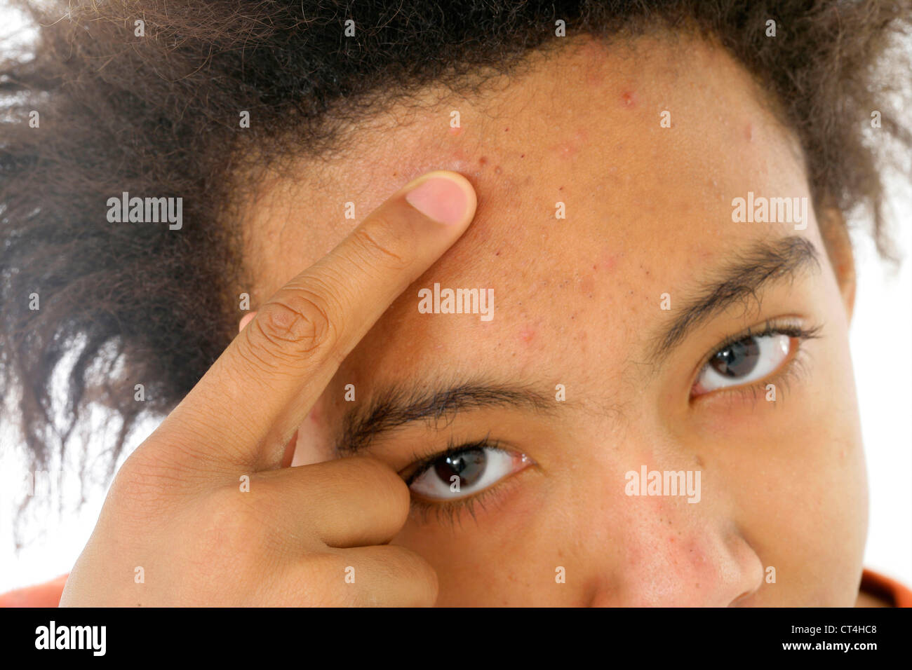 African teen acne hi-res stock photography and images - Alamy