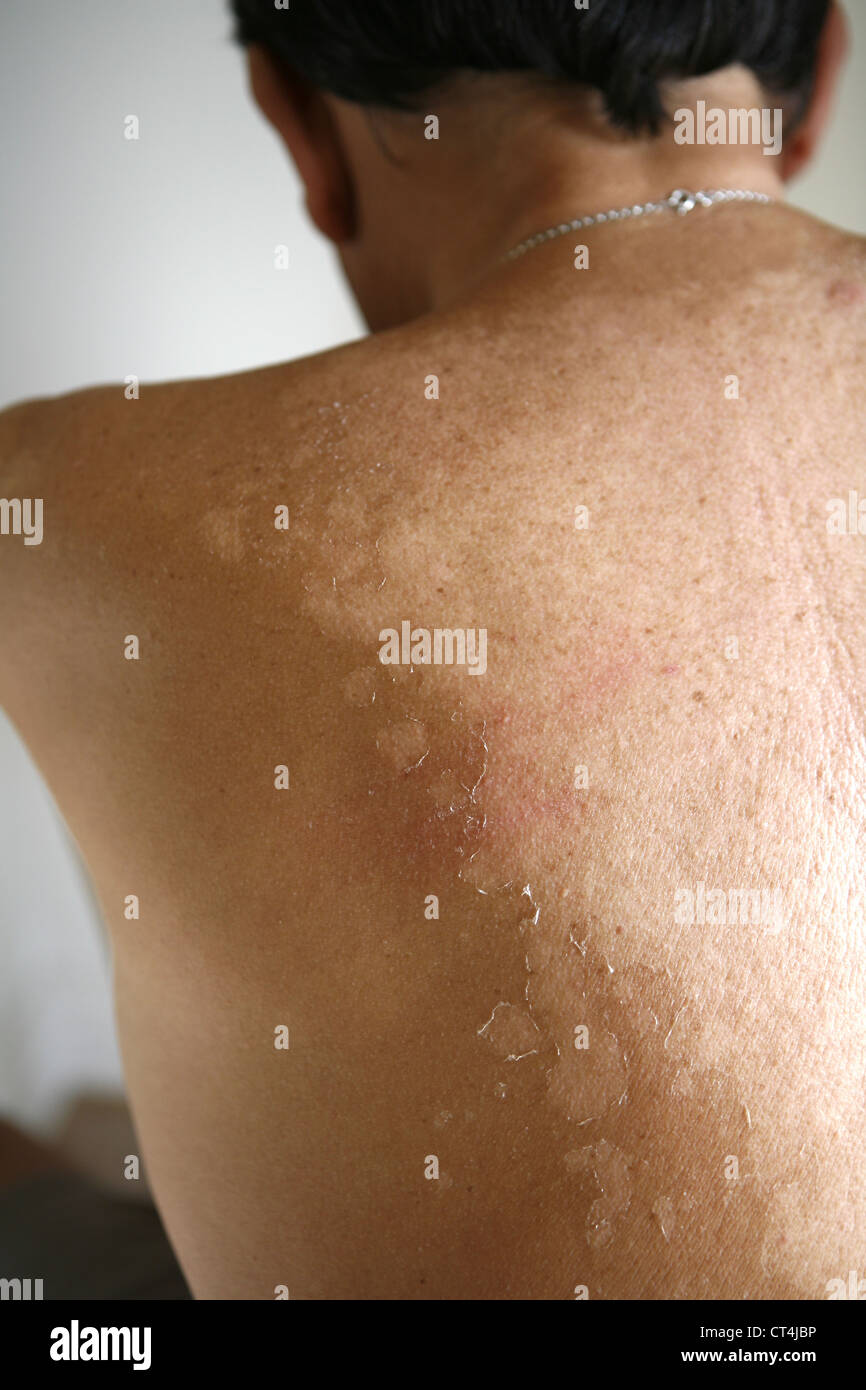 Erythematous hi-res stock photography and images - Alamy