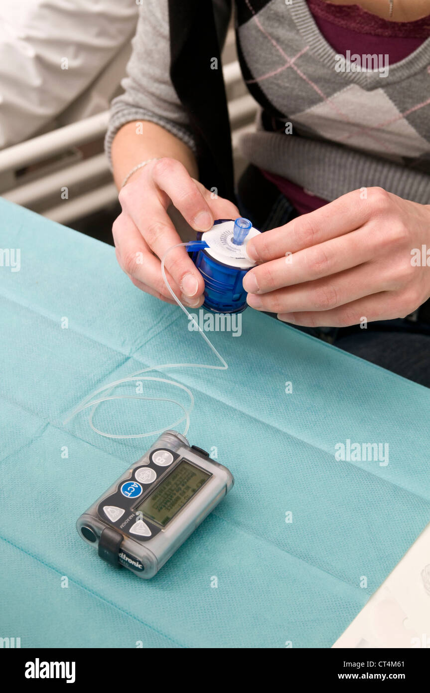 EXTERNAL INSULIN PUMP Stock Photo - Alamy