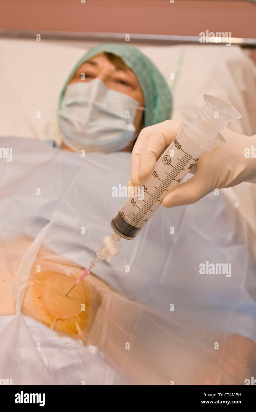 IMPLANTABLE INSULINE POMPE Stock Photo - Alamy