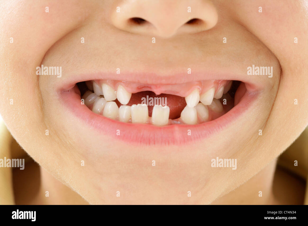 LOSING MILK TEETH Stock Photo - Alamy