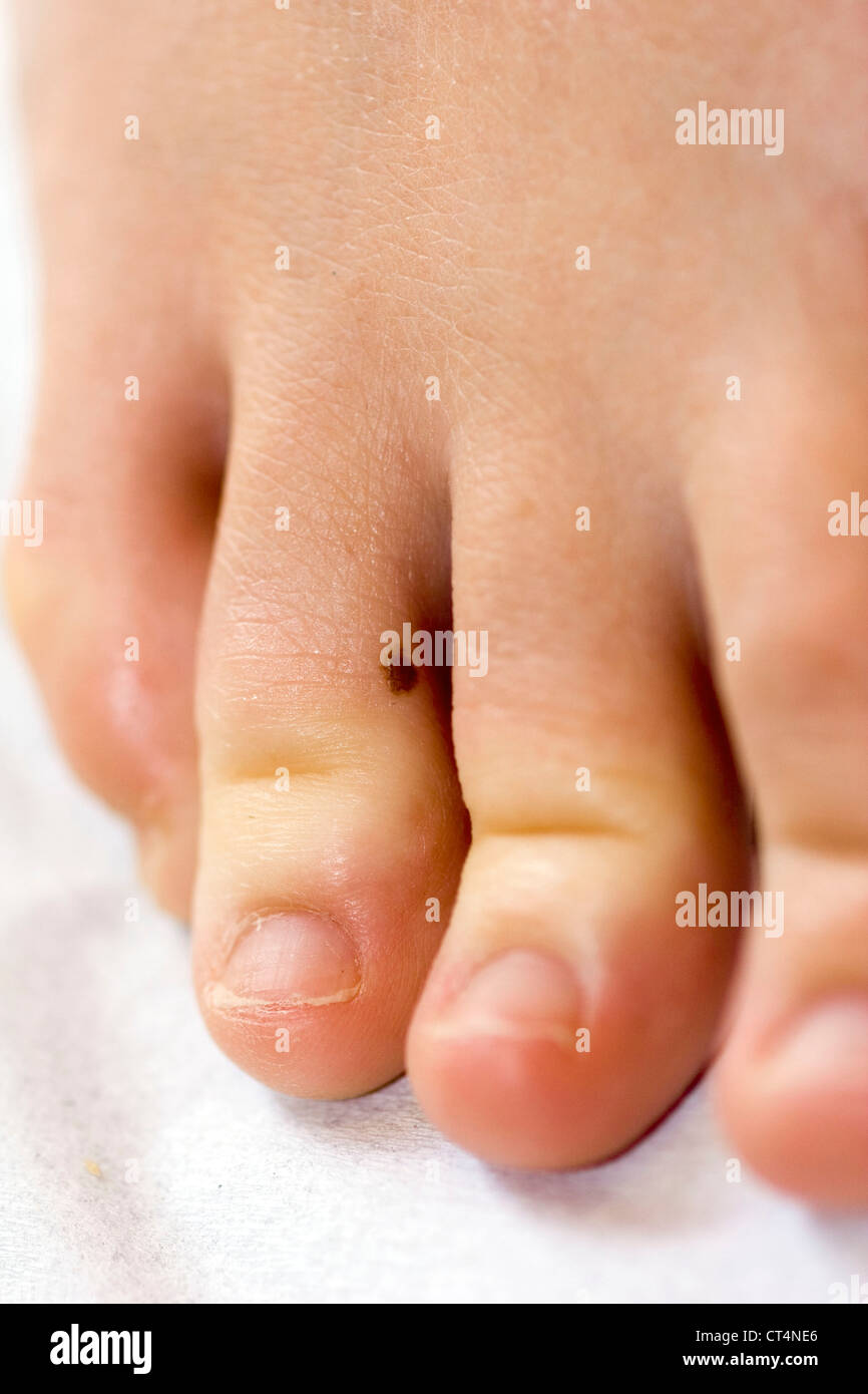 Nevocytic nevus hi-res stock photography and images - Alamy