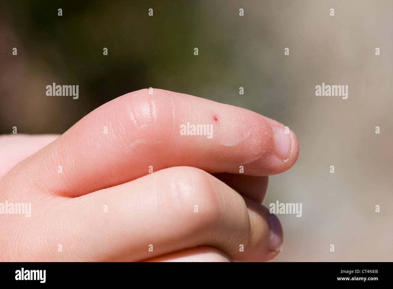 To treat insect sting hi-res stock photography and images - Alamy