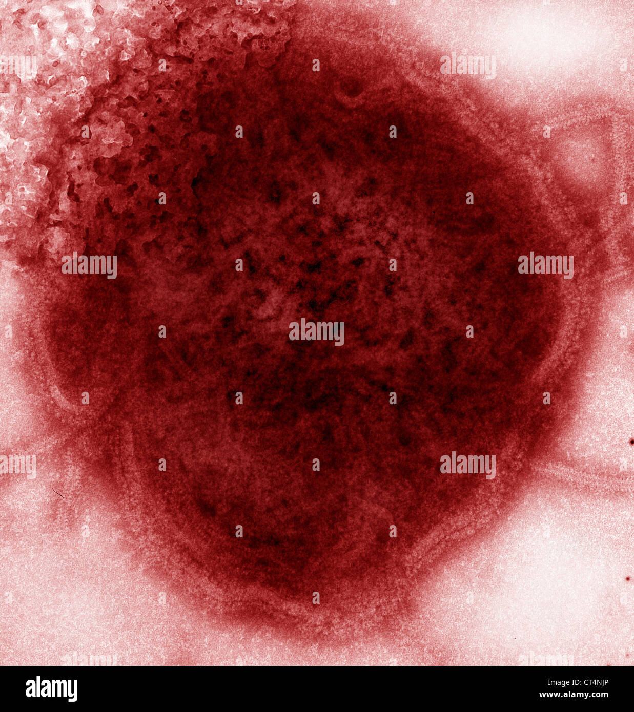 Mumps virus hi-res stock photography and images - Alamy