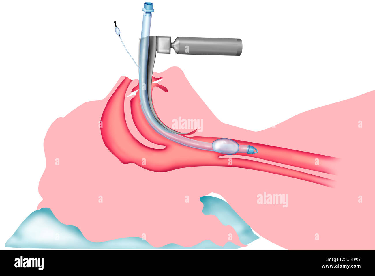 TRACHEAL INTUBATION Stock Photo - Alamy TRACHEAL INTUBATION Stock Photo - Alamy