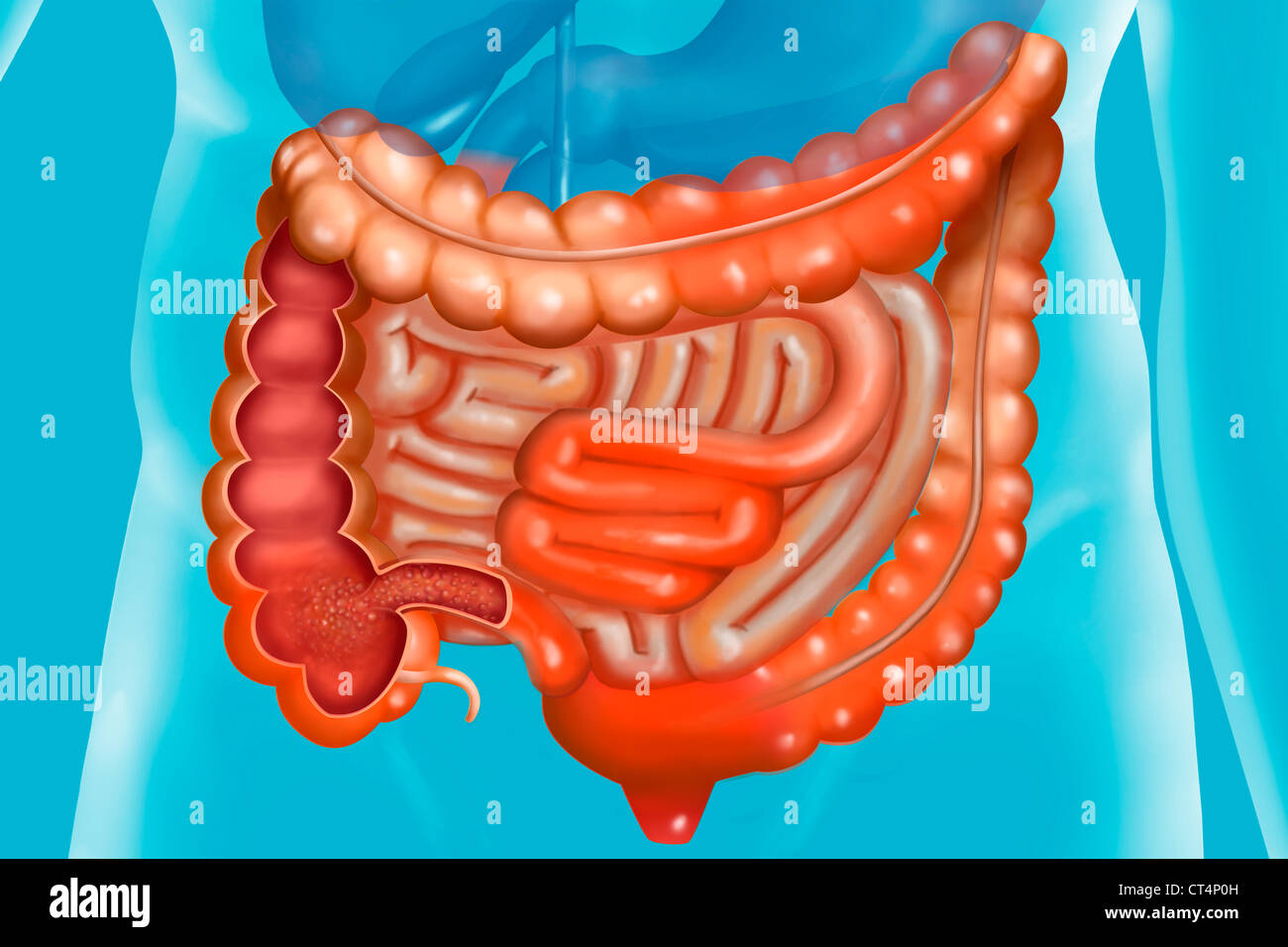 CROHN'S DISEASE, DRAWING Stock Photo - Alamy