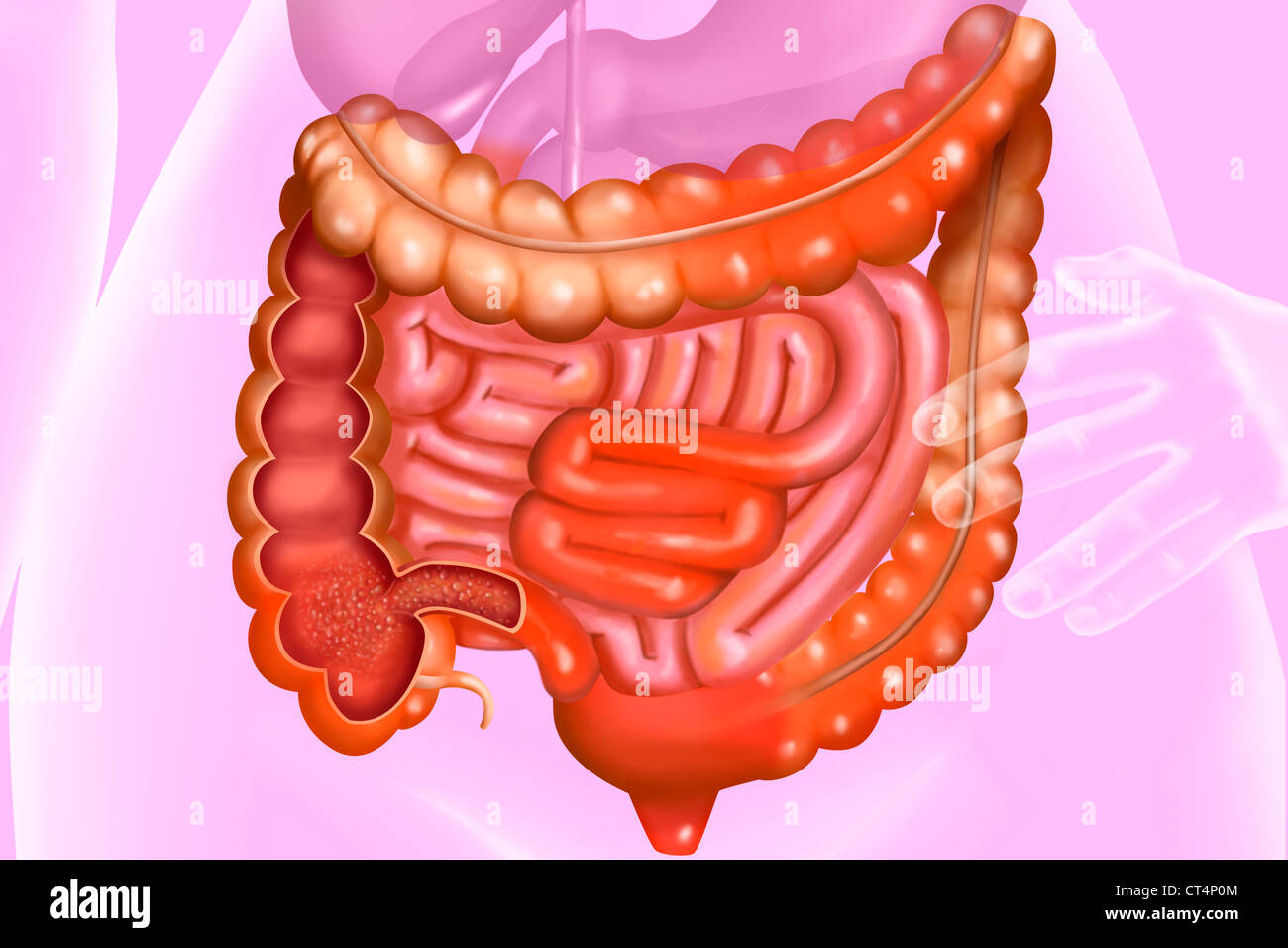 Crohn's Disease Illustration High Resolution Stock Photography and ...