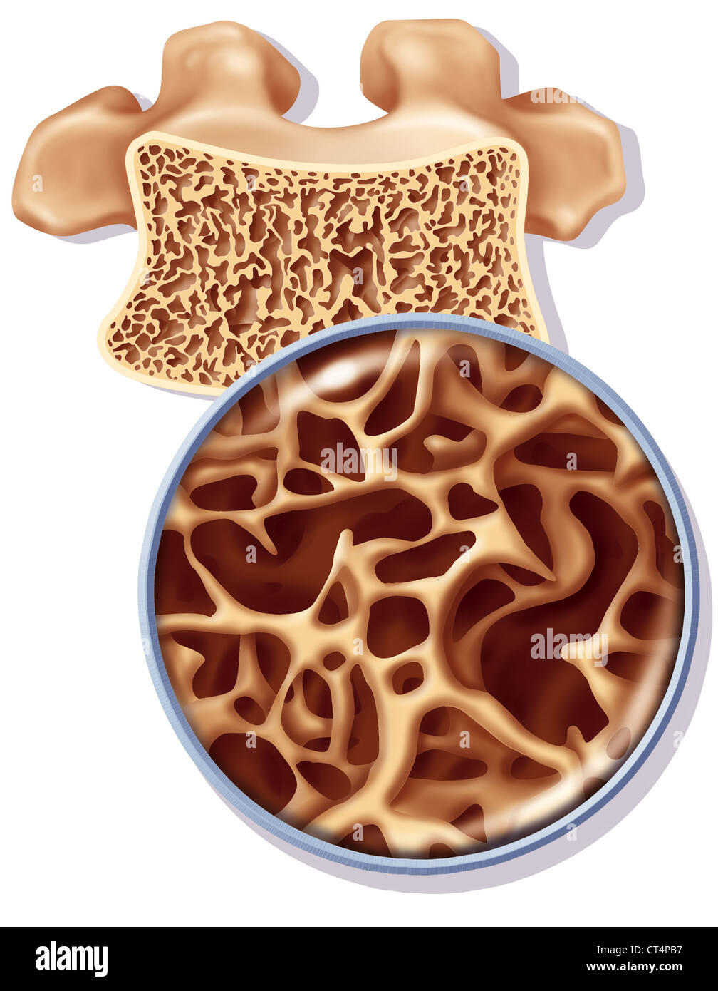 Bone demineralization Cut Out Stock Images & Pictures - Alamy