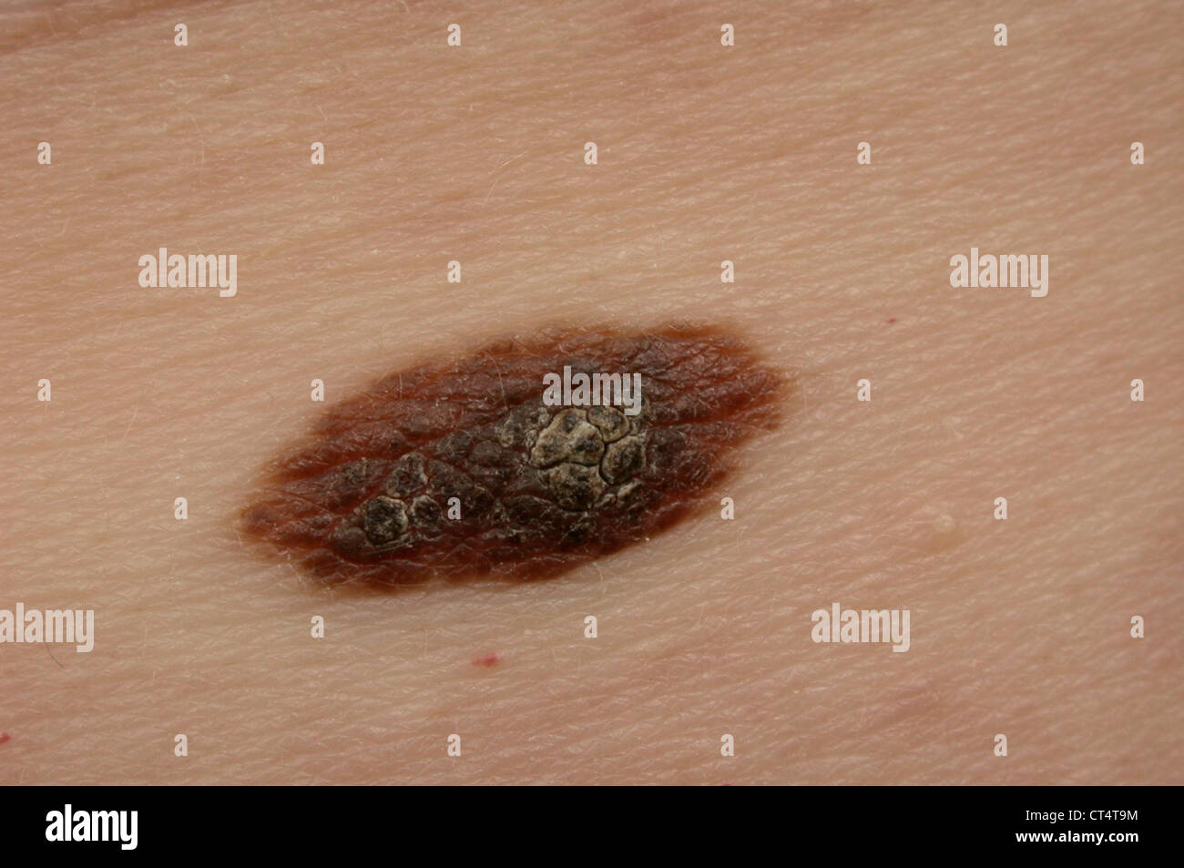 Nevus naevocytic hi-res stock photography and images - Alamy