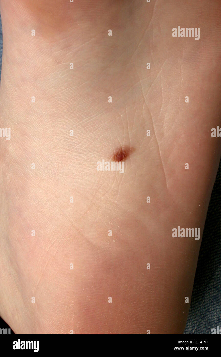 NEVUS Stock Photo - Alamy