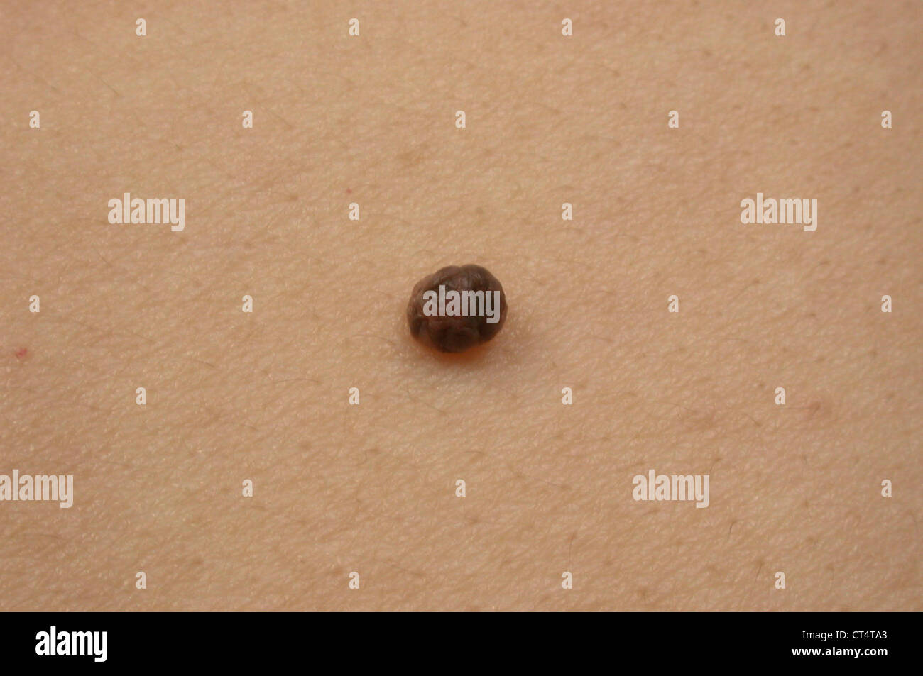 Seborrheic Warts High Resolution Stock Photography and Images - Alamy