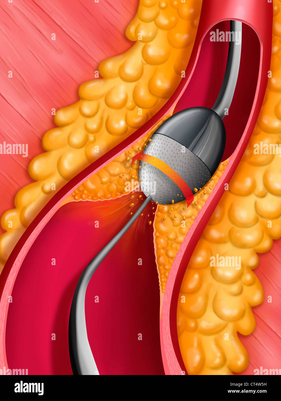 Atherectomy hi-res stock photography and images - Alamy