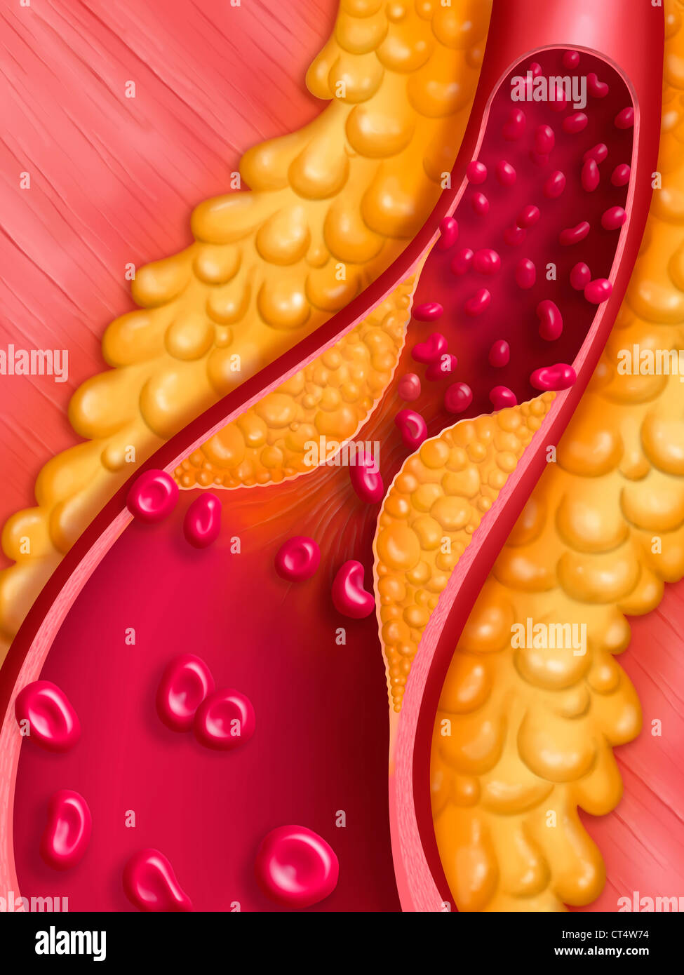 Atheroma plaques hi-res stock photography and images - Alamy
