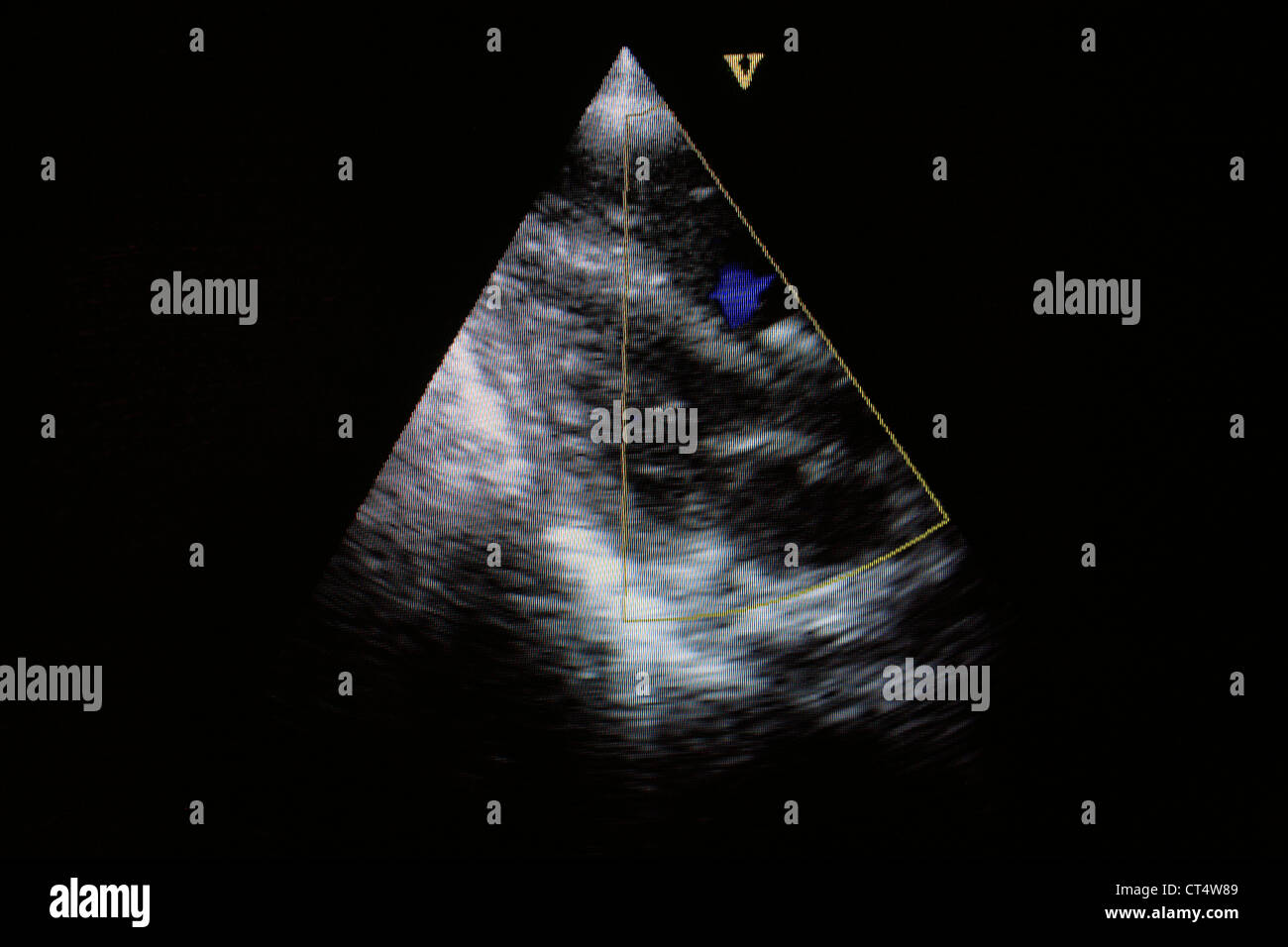 HEART, SONOGRAPHY RESULT Stock Photo - Alamy