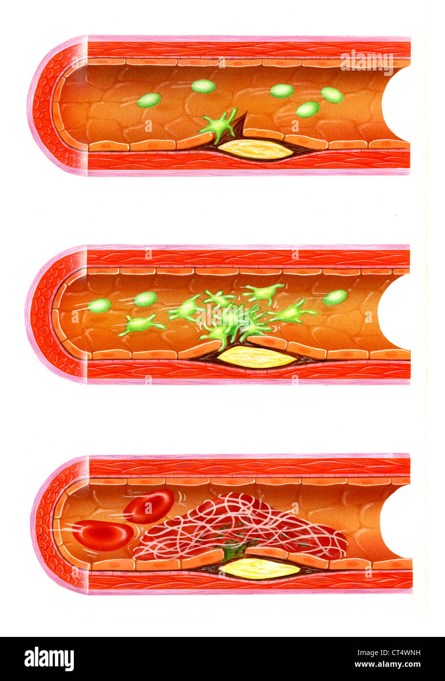 Activated platelets and red blood cells hi-res stock photography and ...