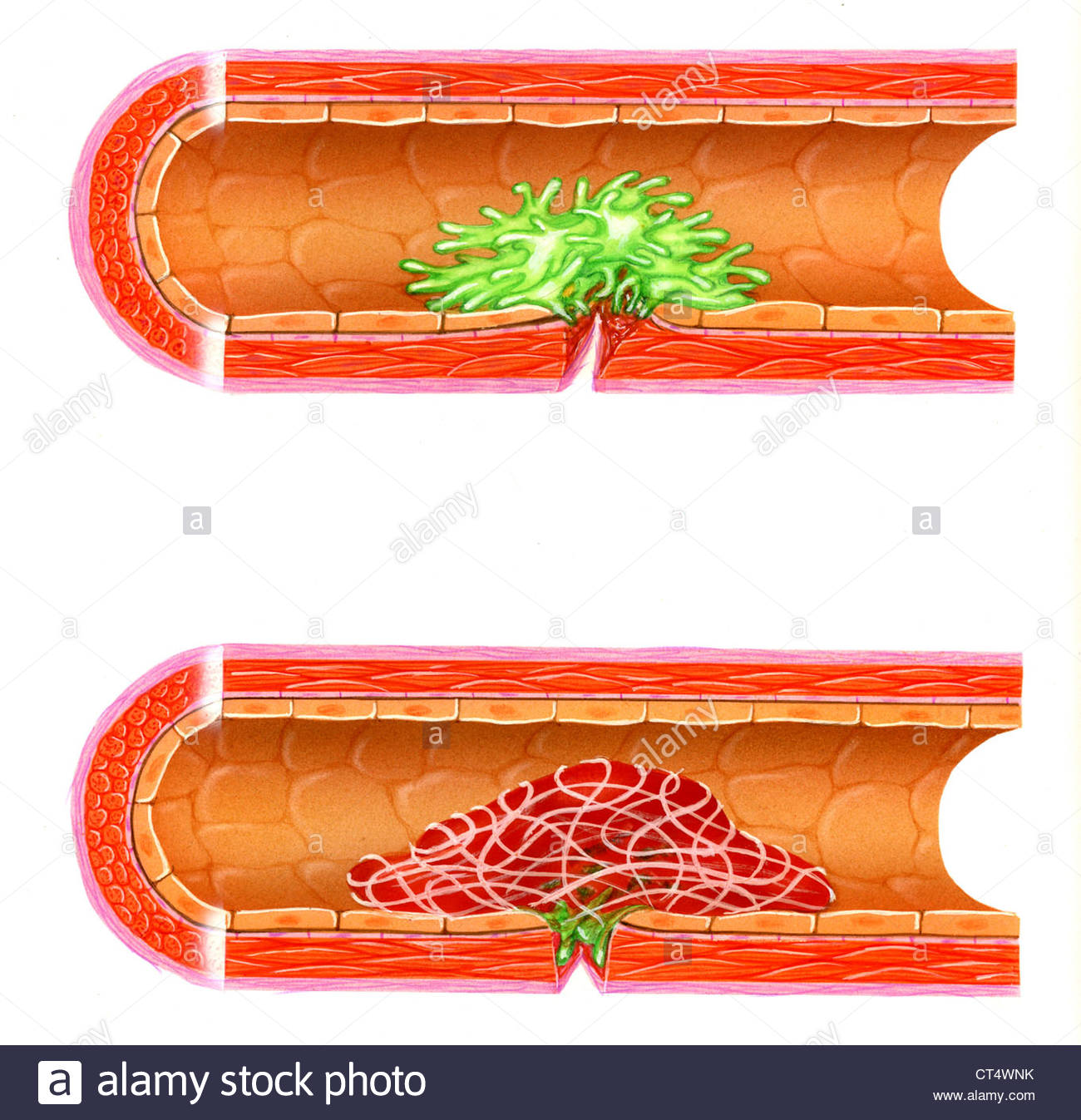 Coagulation Stock Photos & Coagulation Stock Images - Alamy