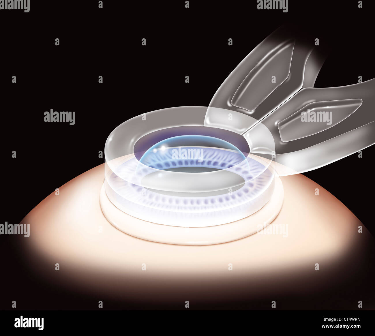 Lasik Stock Photos & Lasik Stock Images - Alamy