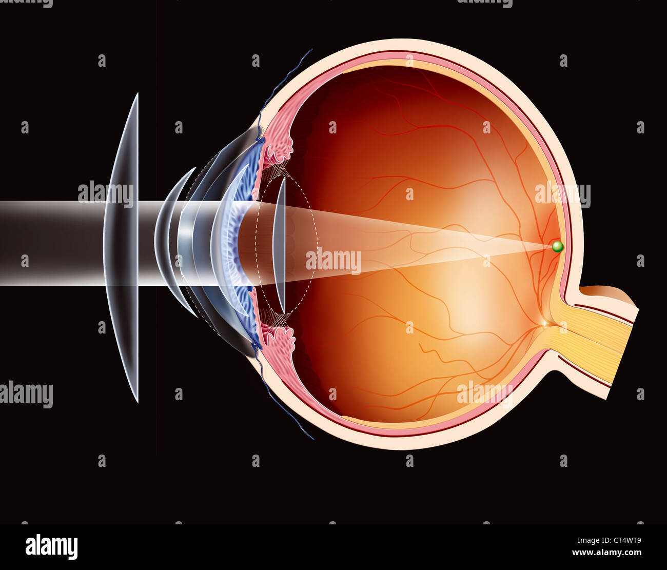Hyperopia drawing hi-res stock photography and images - Alamy