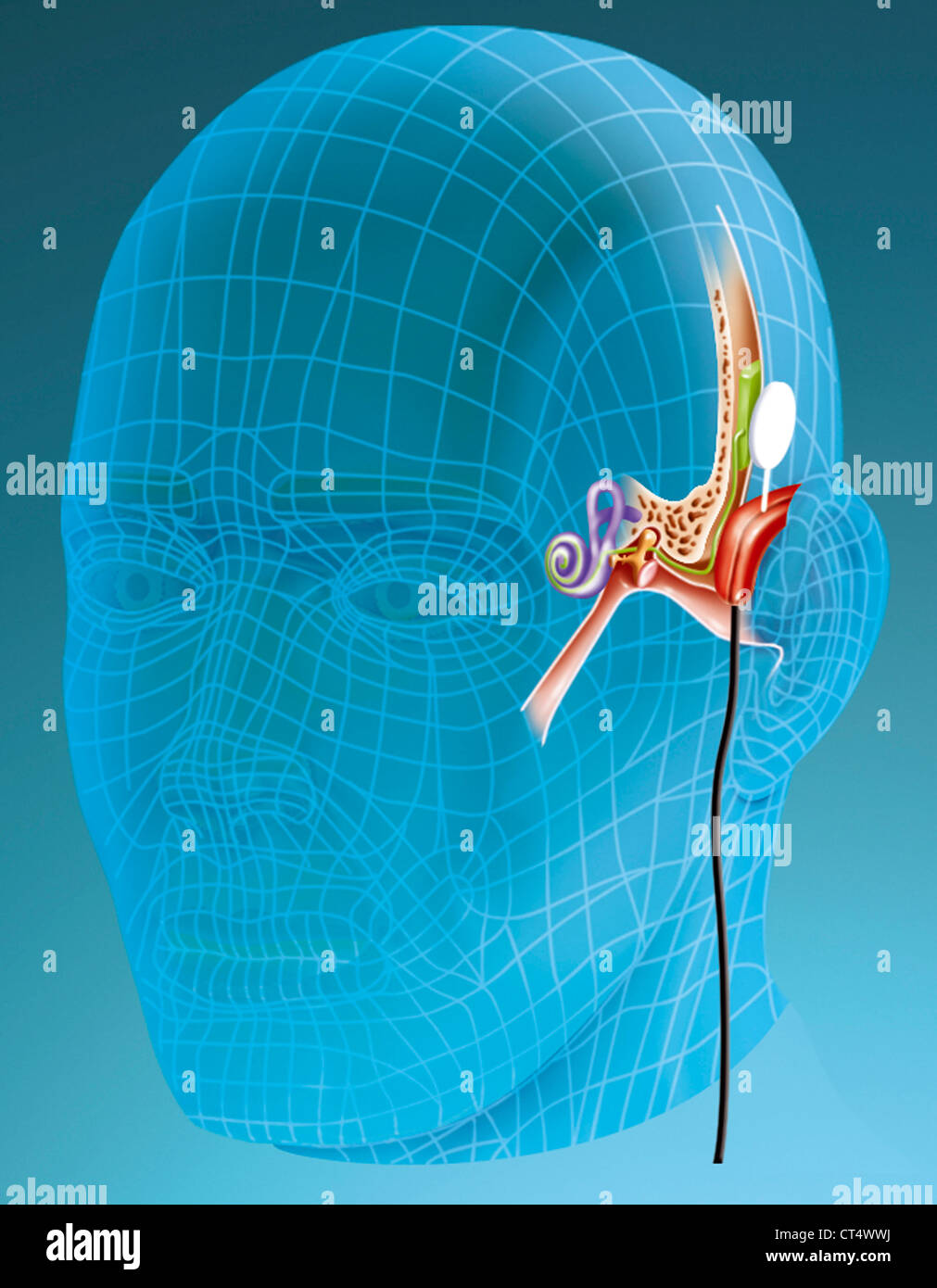 Cochlear implant hearing device hi-res stock photography and images - Alamy