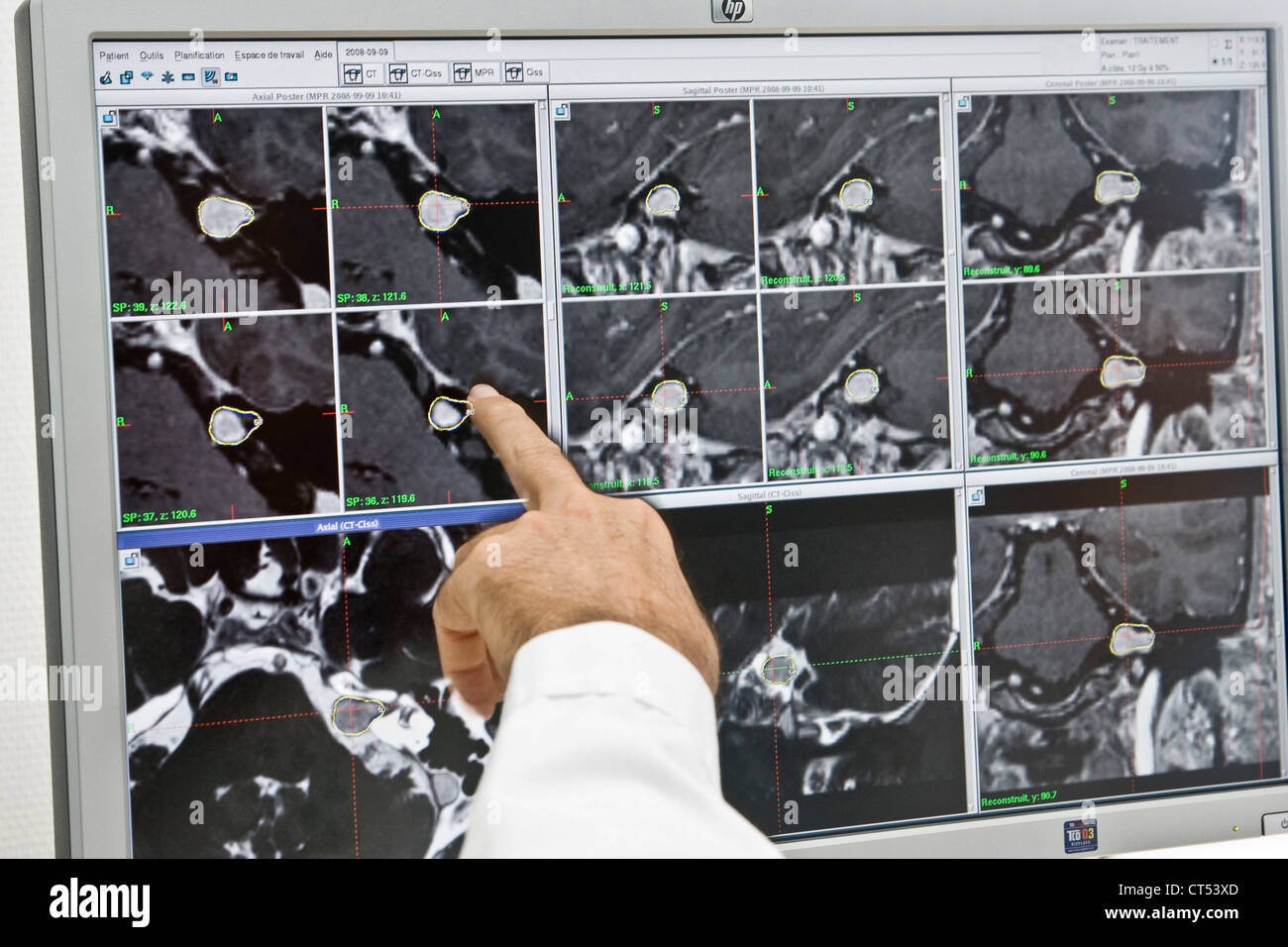 Acoustic Neuroma Monitoring at Adriana Fishburn blog
