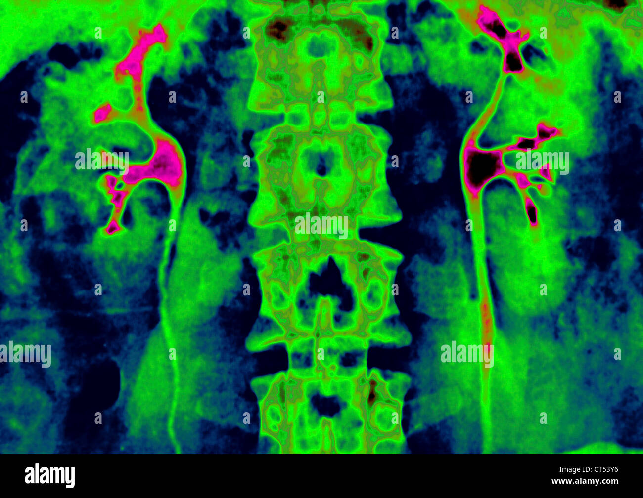 X ray urinary system normal hi-res stock photography and images - Alamy