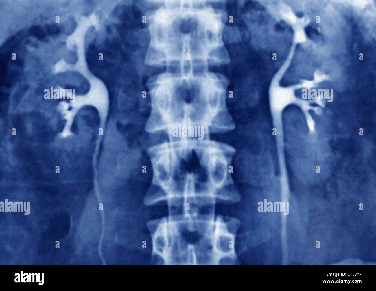 Pyelon hi-res stock photography and images - Alamy