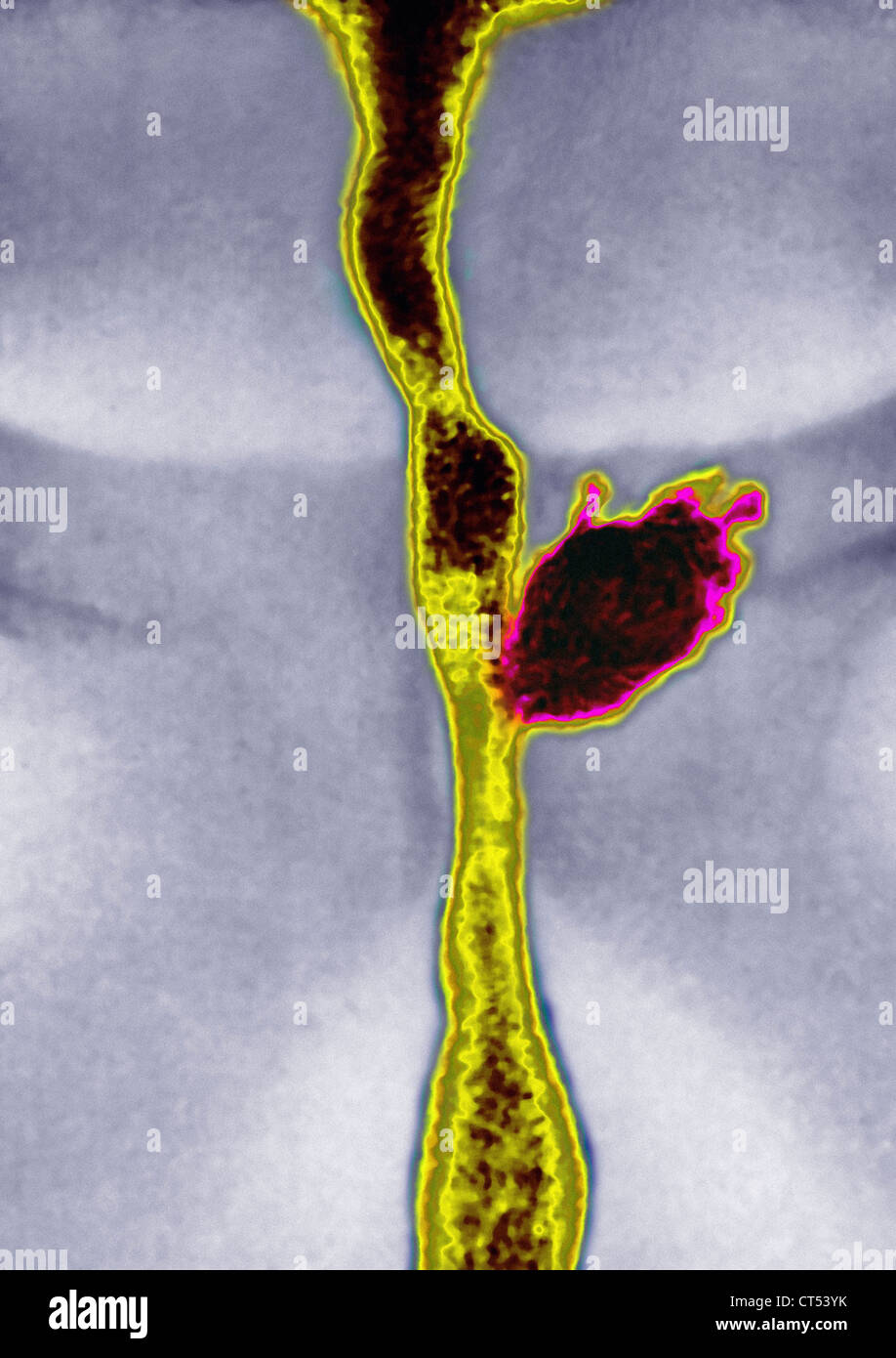 PROSTATIC ABSCESS, X-RAY Stock Photo - Alamy