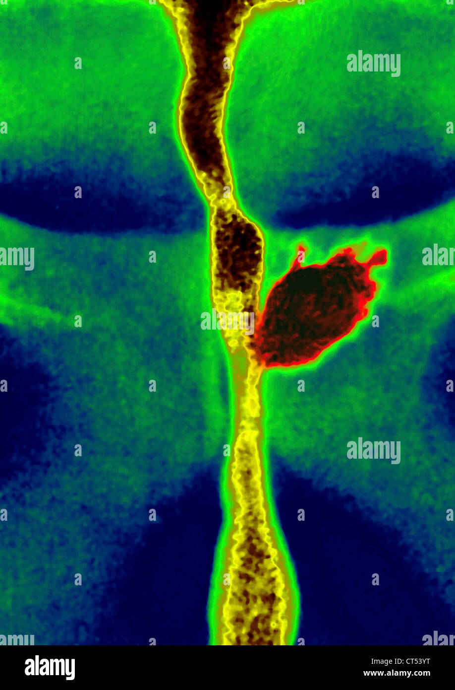 PROSTATIC ABSCESS, X-RAY Stock Photo - Alamy