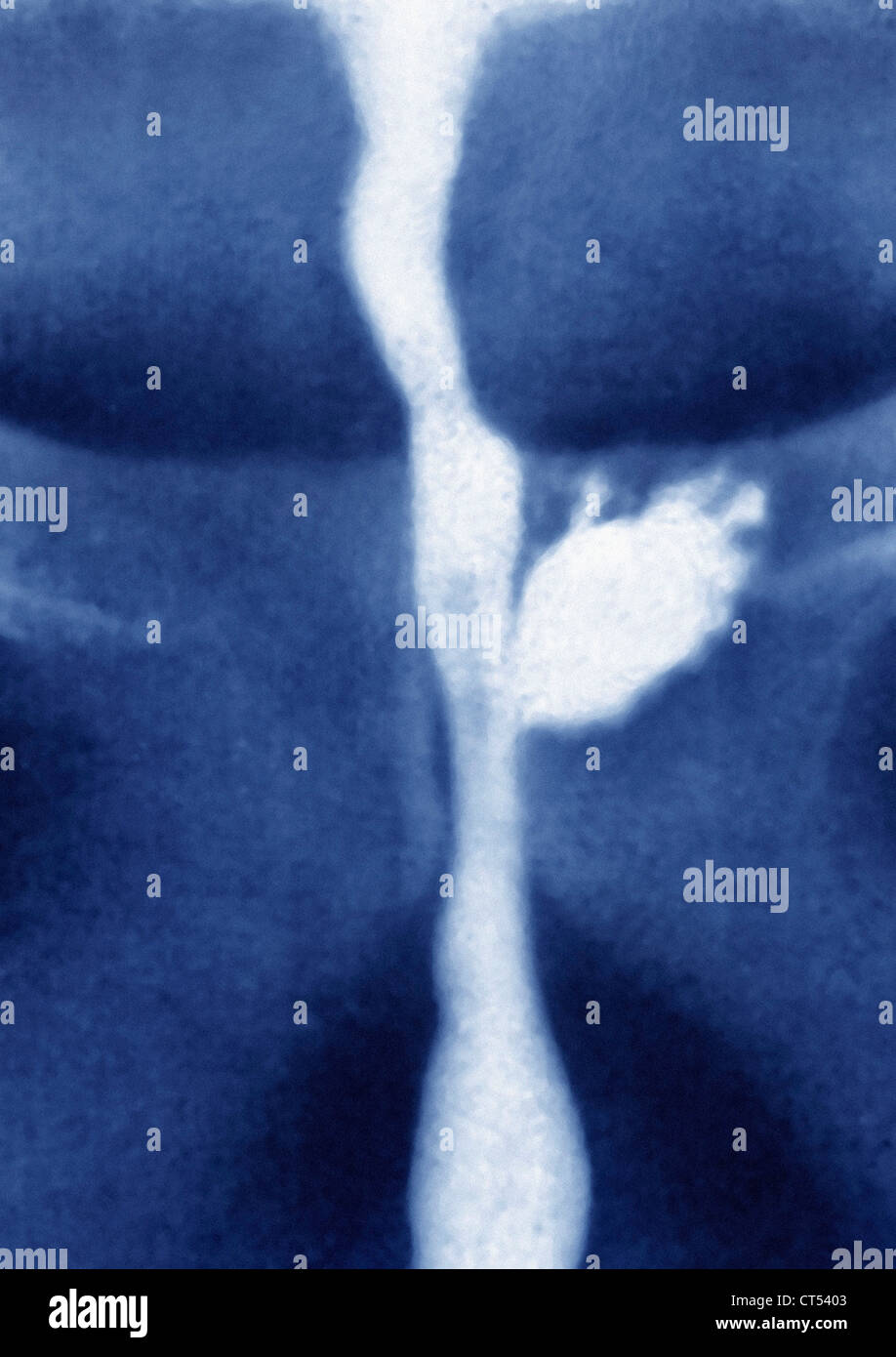 PROSTATIC ABSCESS, X-RAY Stock Photo - Alamy