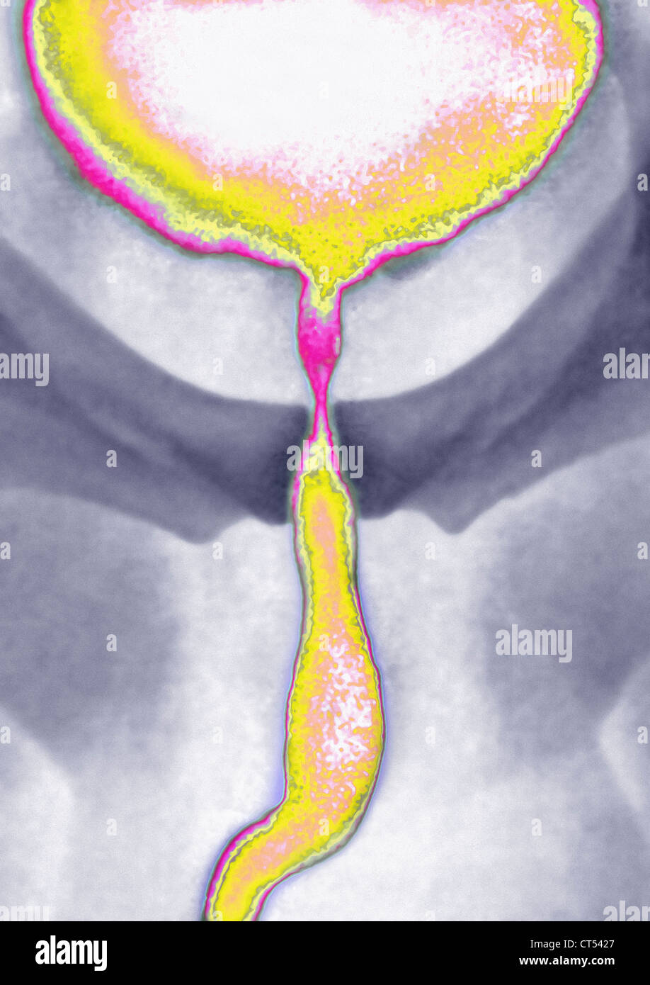 MALE URETHRA, X-RAY Stock Photo - Alamy