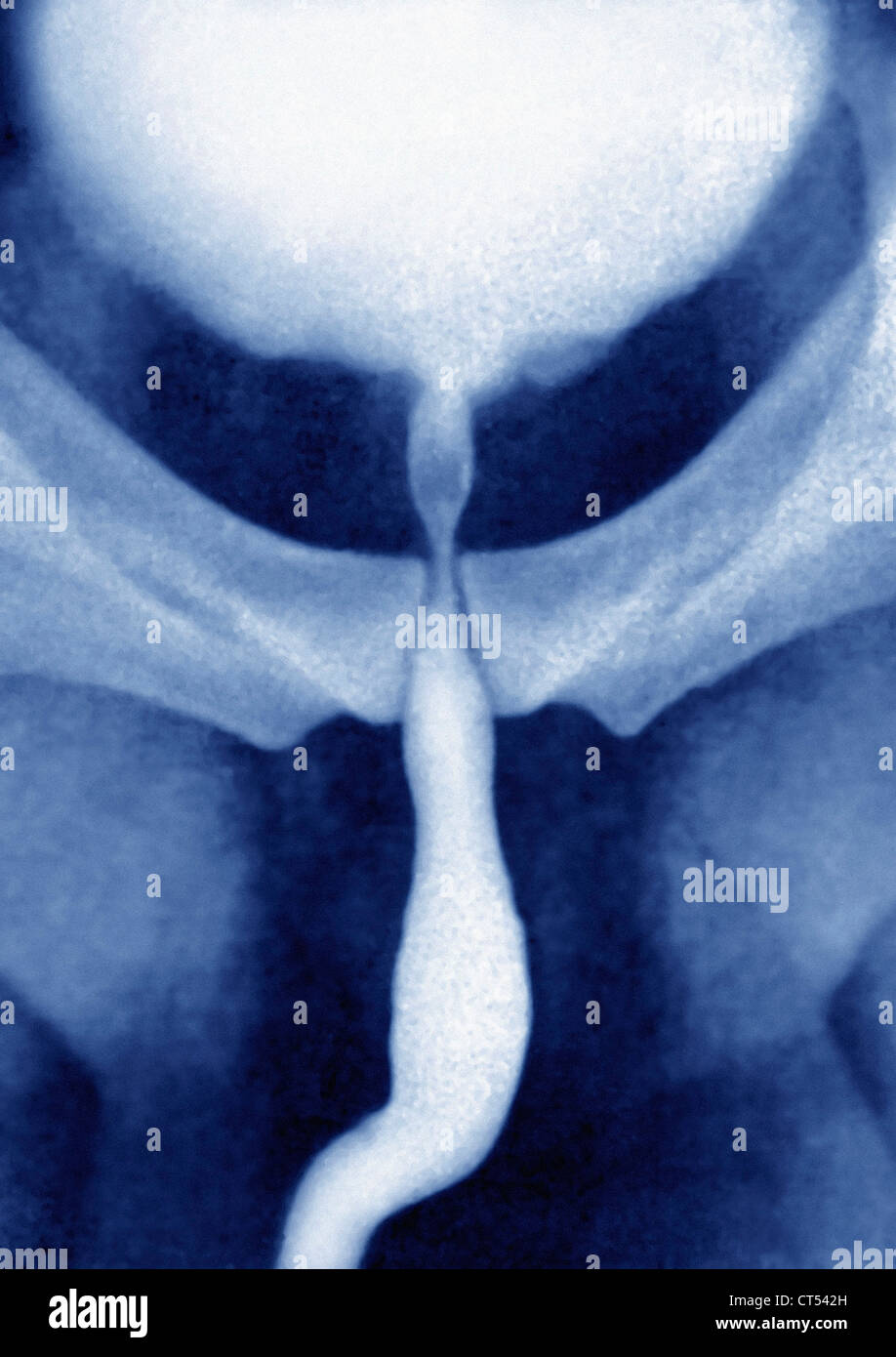 MALE URETHRA, X-RAY Stock Photo - Alamy