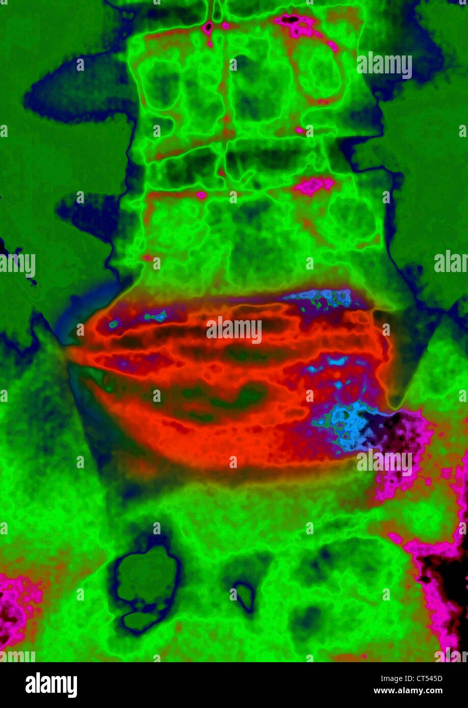 CAUDA EQUINA SYNDROME Stock Photo - Alamy