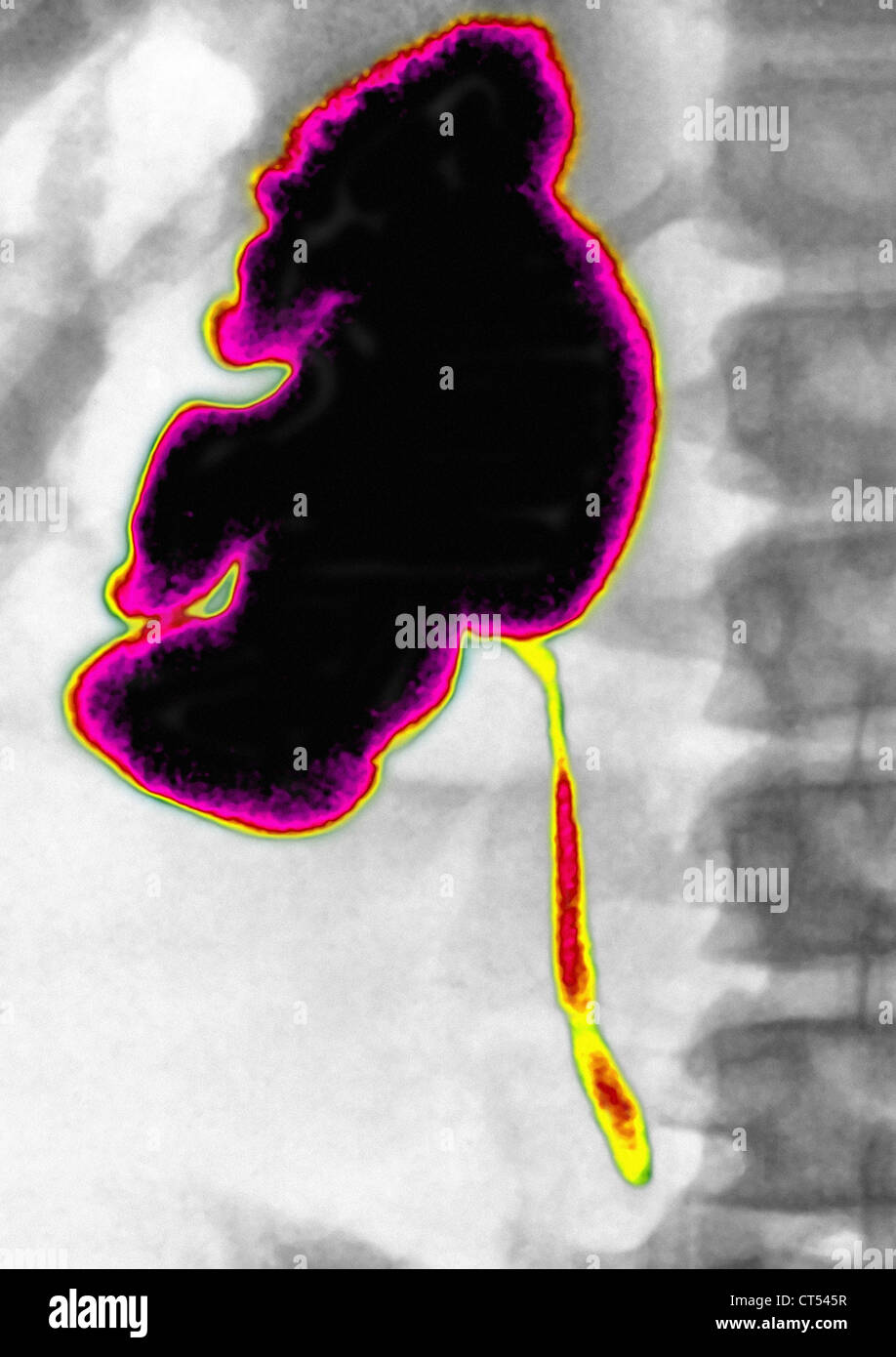 Renal lithiasis hi-res stock photography and images - Alamy