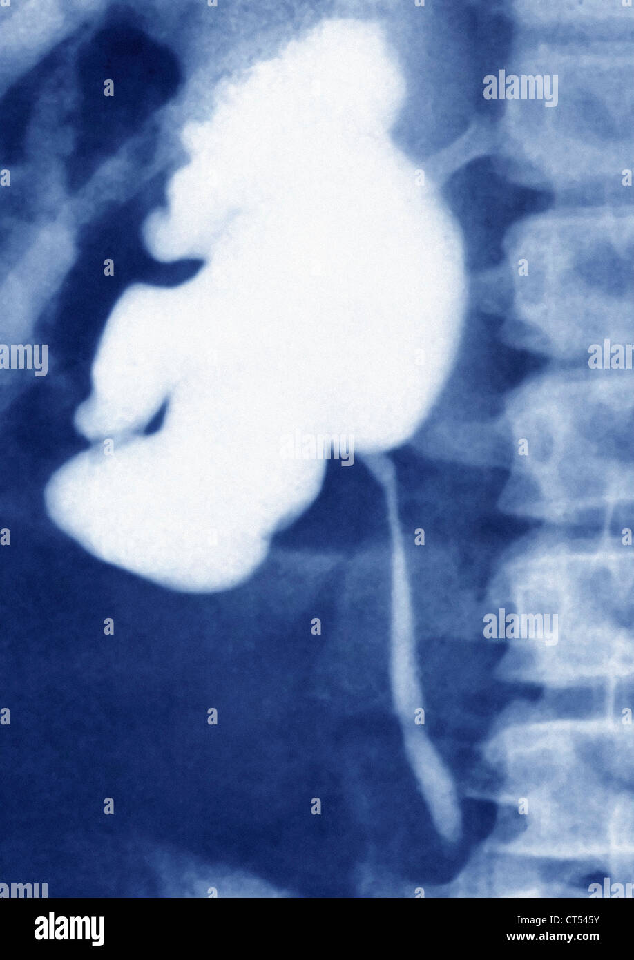 URETERAL LITHIASIS, X-RAY Stock Photo - Alamy