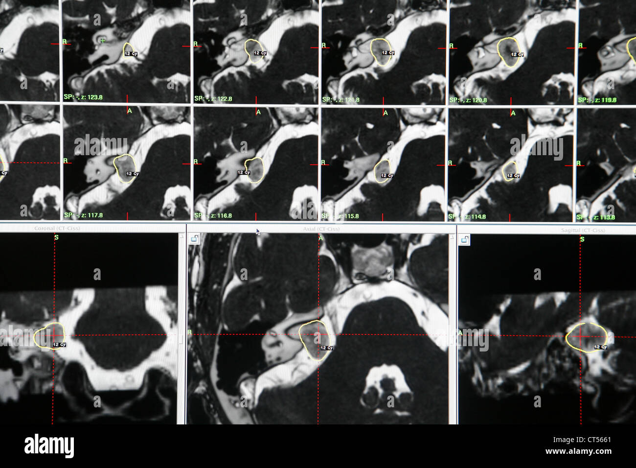 Verona Geographer Acoustic Neuroma [PDF] Pain. Part 7: Trigeminal ...