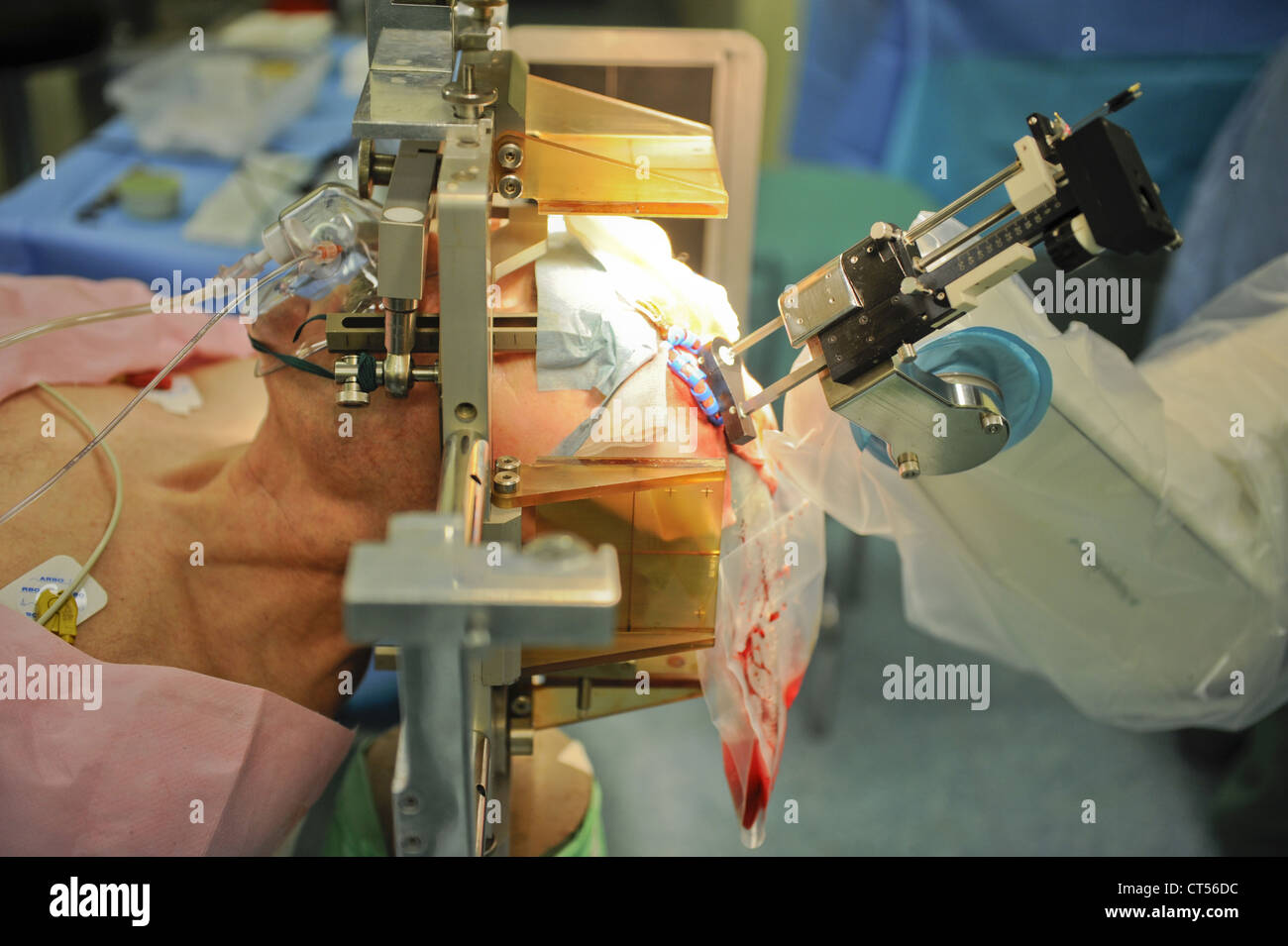 Electrostimulation, brain hi-res stock photography and images - Alamy