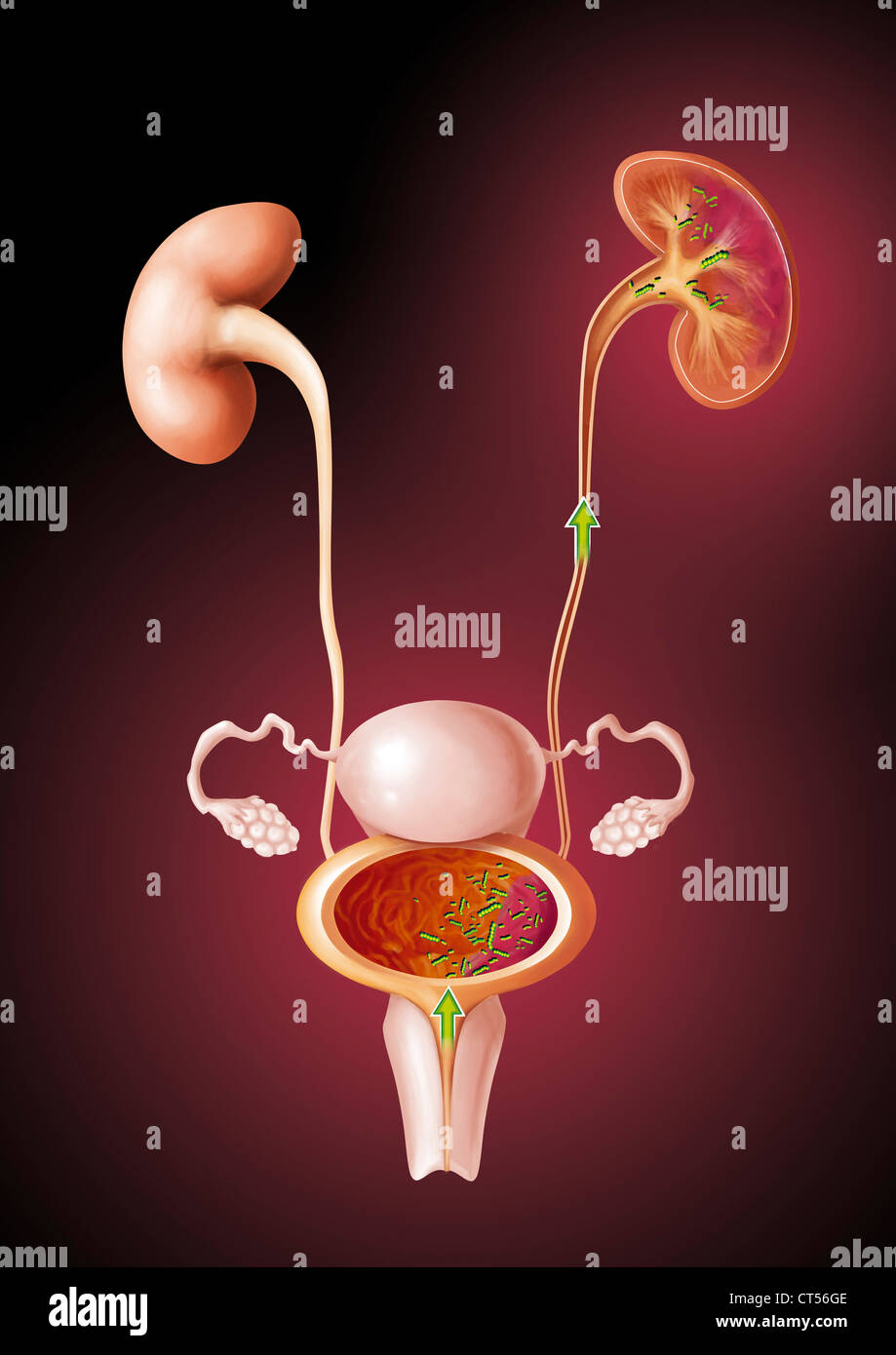 Pyelitis hi-res stock photography and images - Alamy