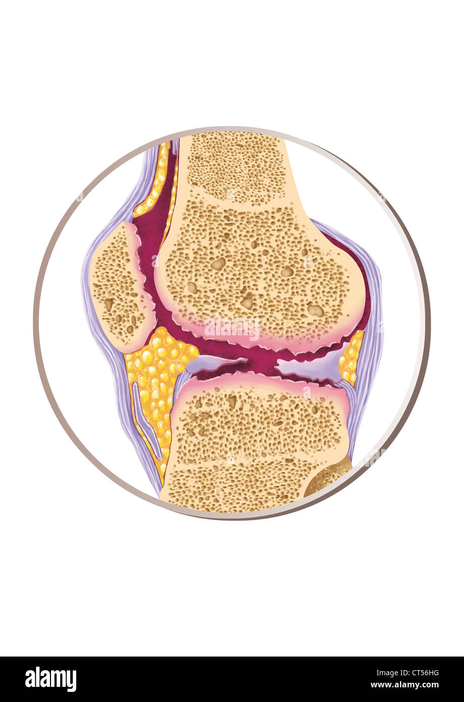 KNEE OSTEOARTHRITIS, DRAWING Stock Photo - Alamy