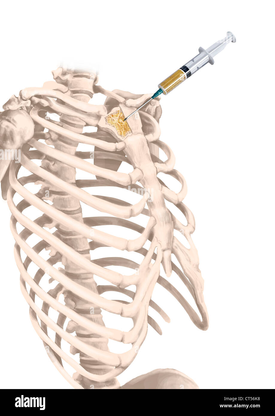BONE MARROW ASPIRATION Stock Photo - Alamy