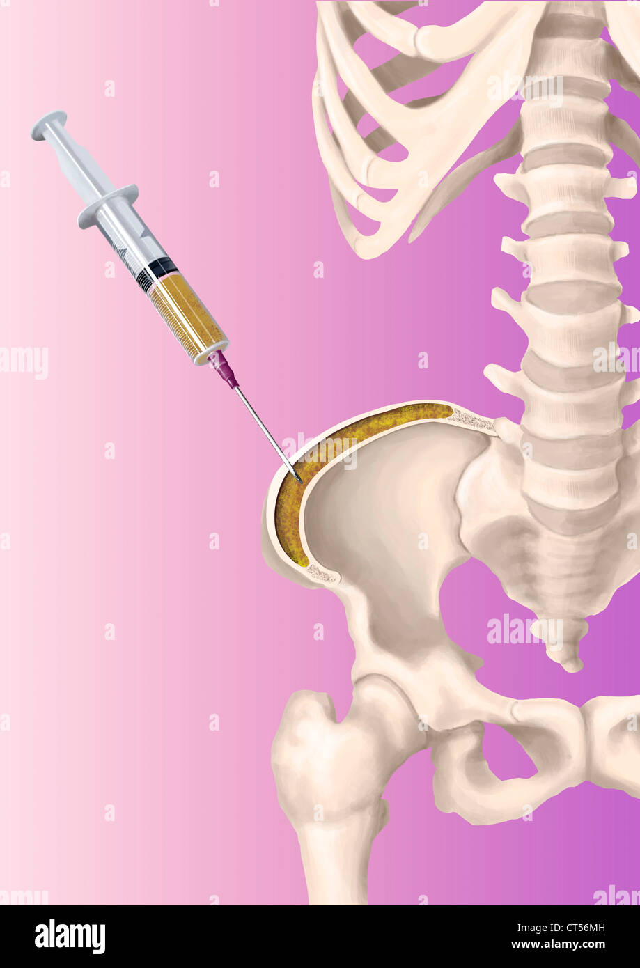 Hip bone graft hi-res stock photography and images - Alamy