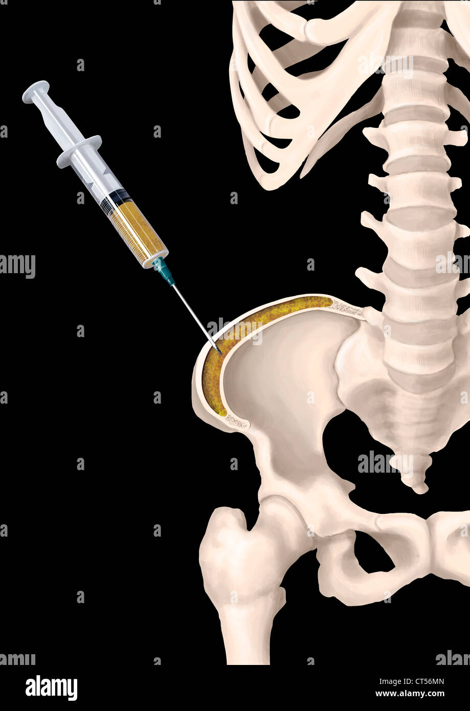 BONE MARROW ASPIRATION Stock Photo - Alamy