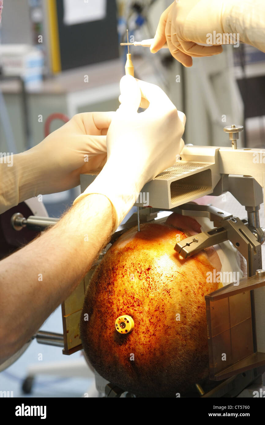 Stereotactic Brain Surgery High Resolution Stock Photography and Images ...