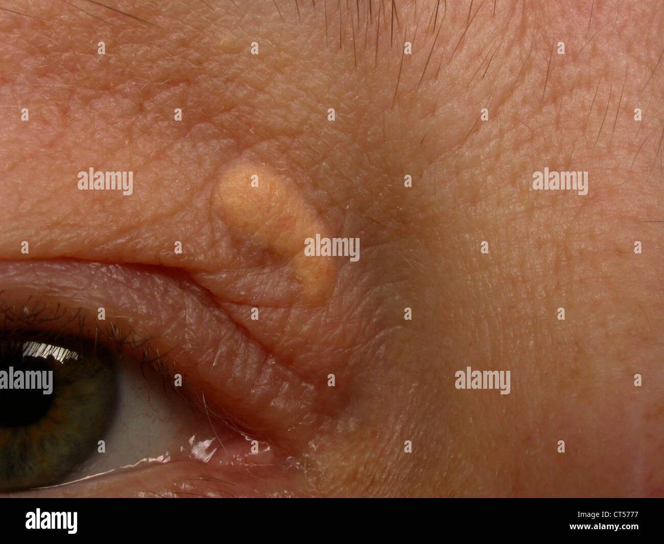 Cholesteatoma hi-res stock photography and images - Alamy