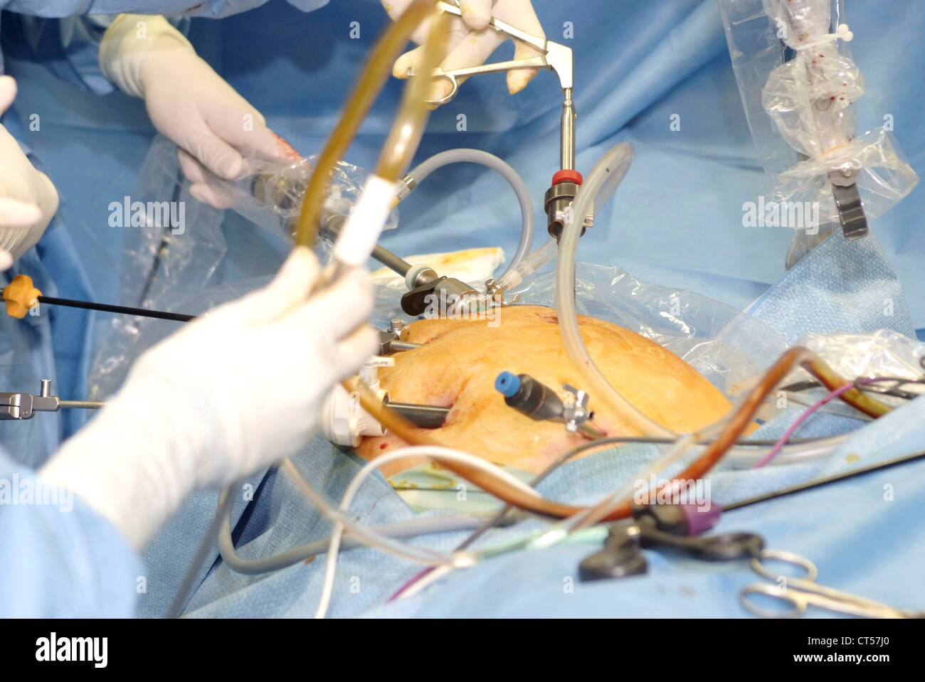 Bowel resection hi-res stock photography and images - Alamy