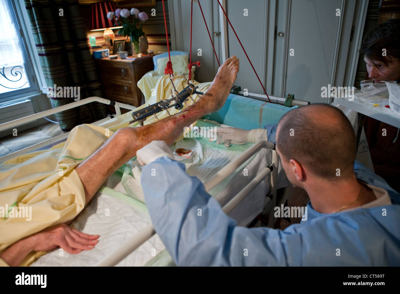 External fixation device hi-res stock photography and images - Alamy