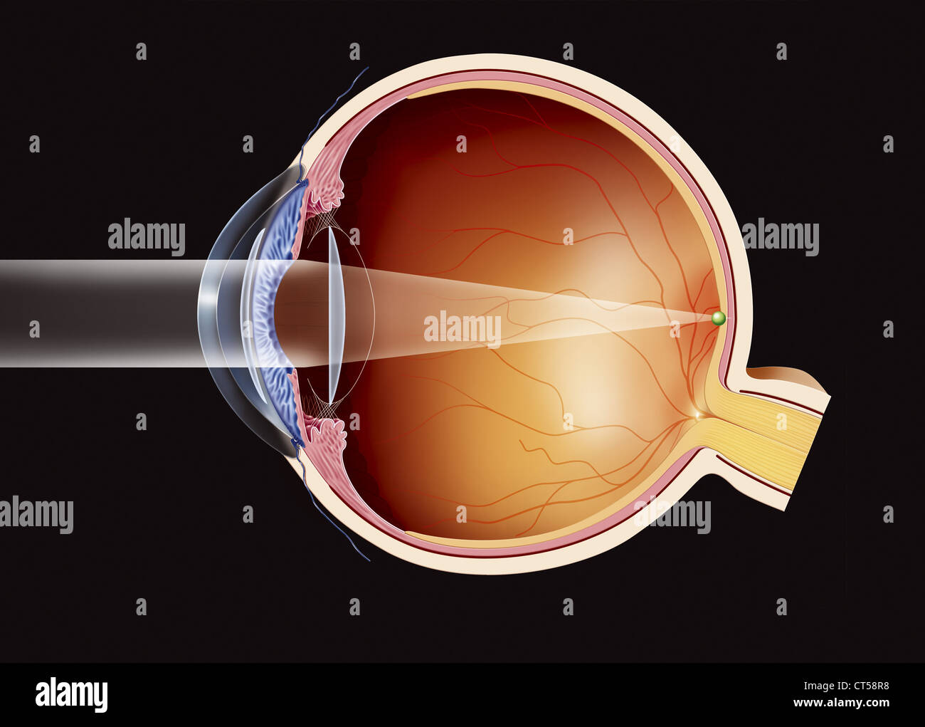 Anterior chamber intraocular lenses hi-res stock photography and images ...