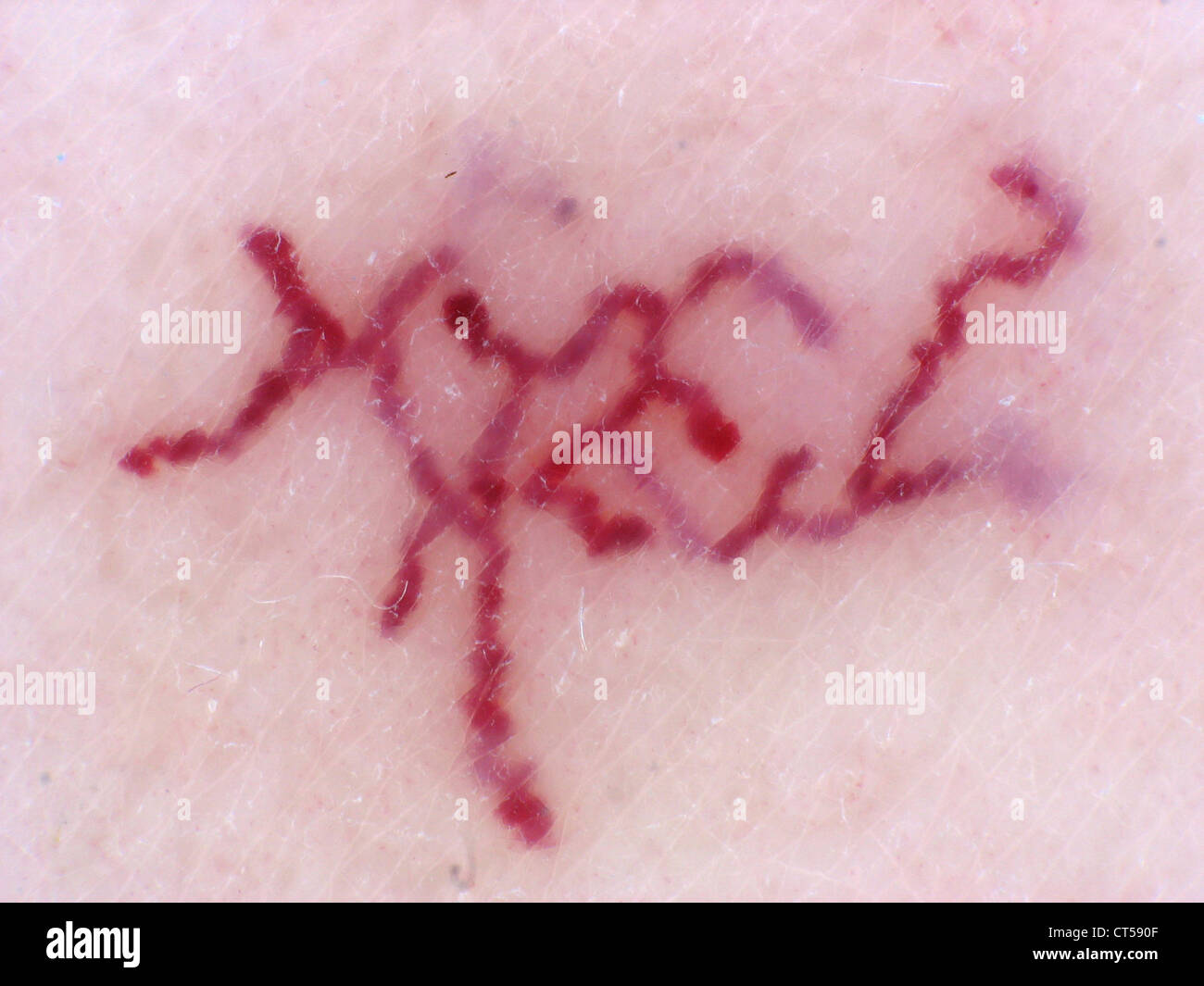 Telangiectasia hi-res stock photography and images - Alamy