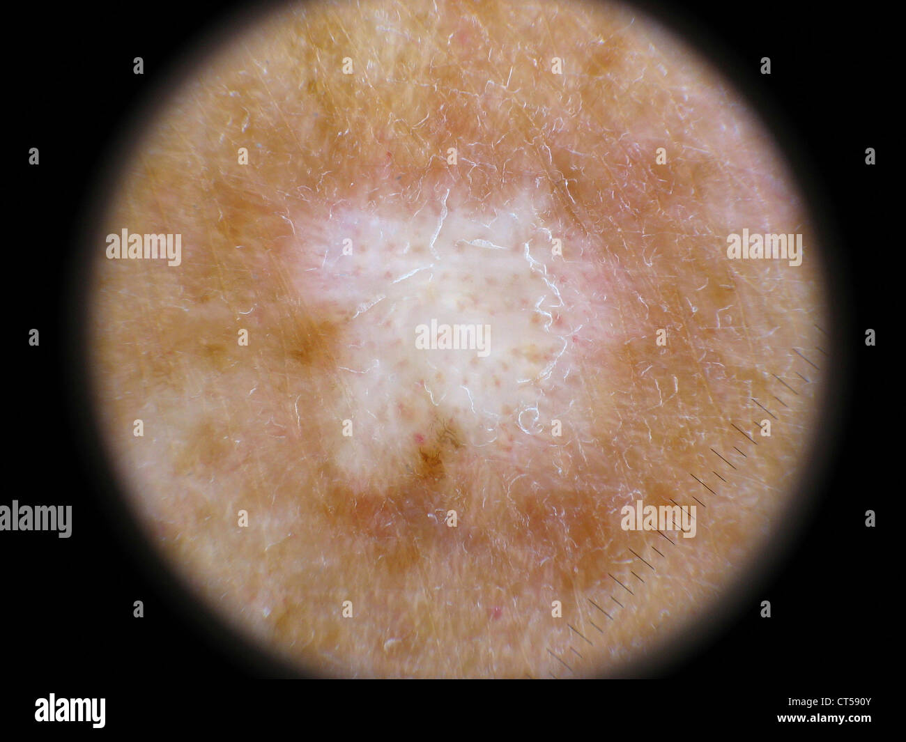 Dermatoscopes High Resolution Stock Photography and Images - Alamy