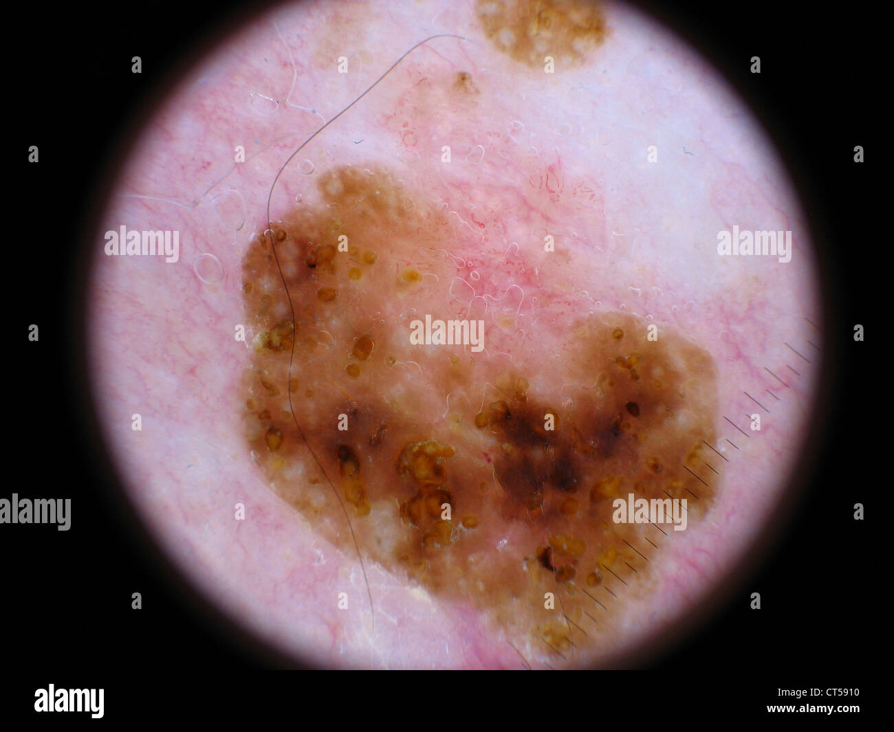 Inflamed Seborrheic Keratosis